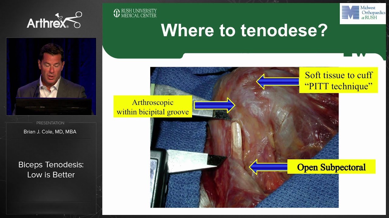 Biceps Tenodesis: Low is Better - YouTube