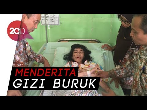 Kasihan, Gadis di Mojokerto Hampir Tersisa Tulang dan Kulit