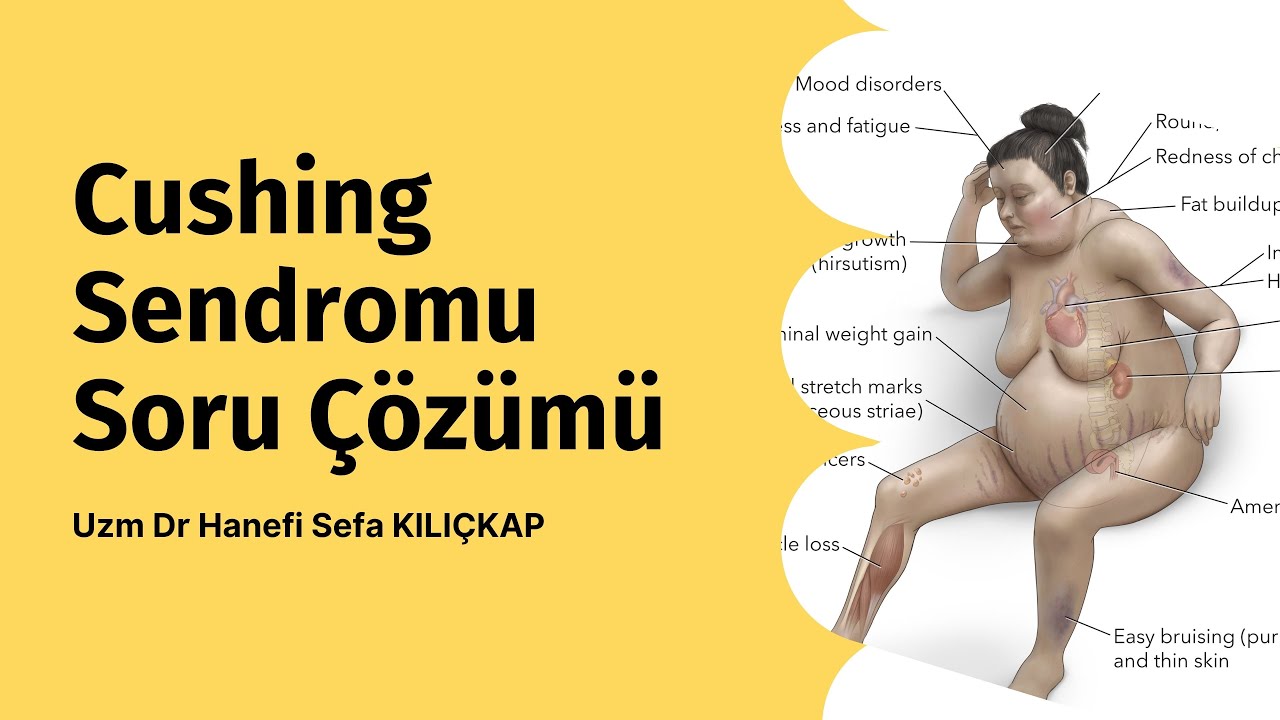 Cushing Sendromu - YouTube