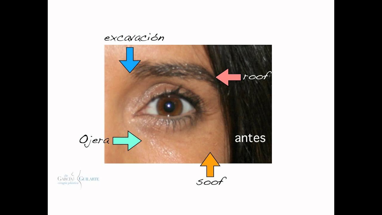 RELLENO DE PARPADO SUPERIOR CON ACIDO HIALURONICO - YouTube