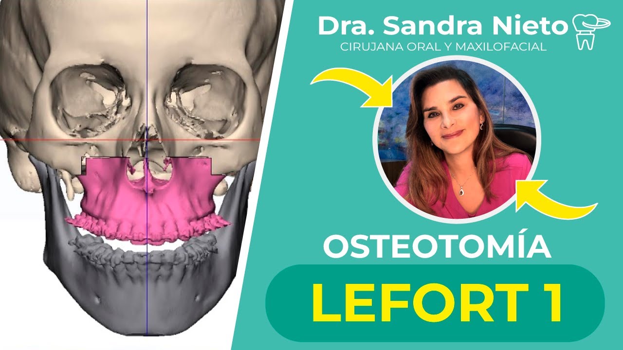 OSTEOTOMÍA LEFORT TIPO 1 - YouTube