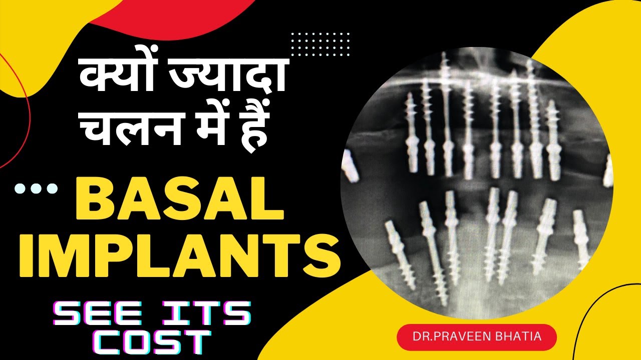 क्यों ज्यादा चलन में हैं BASAL IMPLANTS-SEE ITS COST-Diff between conventional/basal dental ...