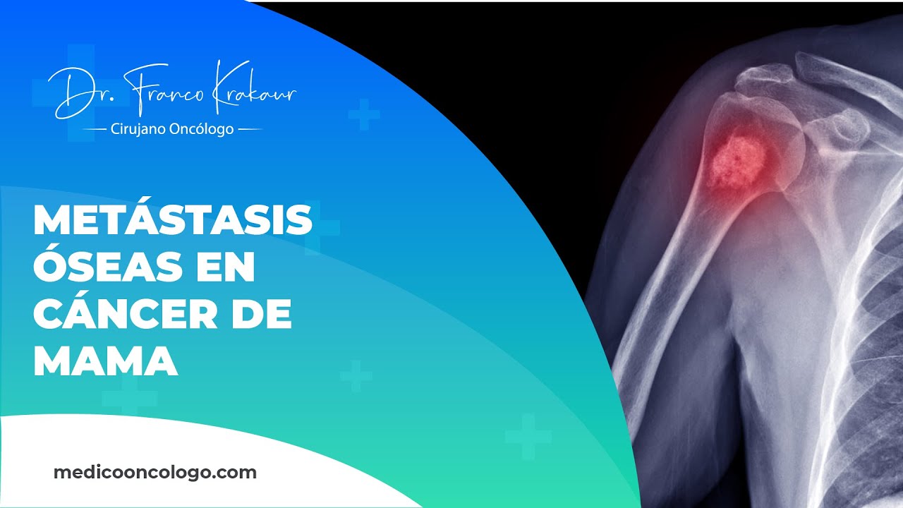 Metástasis Óseas En Cáncer De Mama | Dr. Franco Krakaur | Cirujano ...