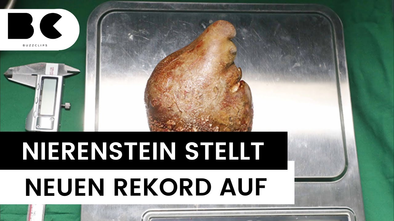 Größter Nierenstein der Welt in Sri Lanka entfernt - YouTube