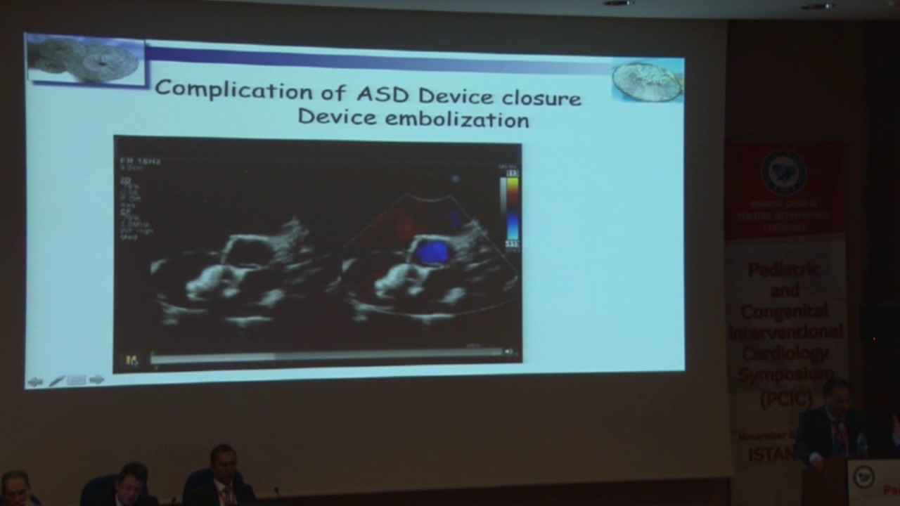 Tarek Momenah Complications during and after ASD closure - YouTube