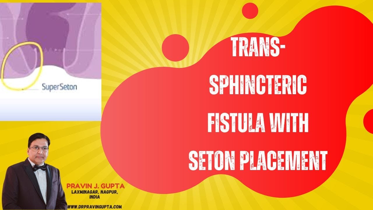 TRANS-SPHINCTERIC FISTULA WITH A DRAINING SETON PLACEMENT - YouTube