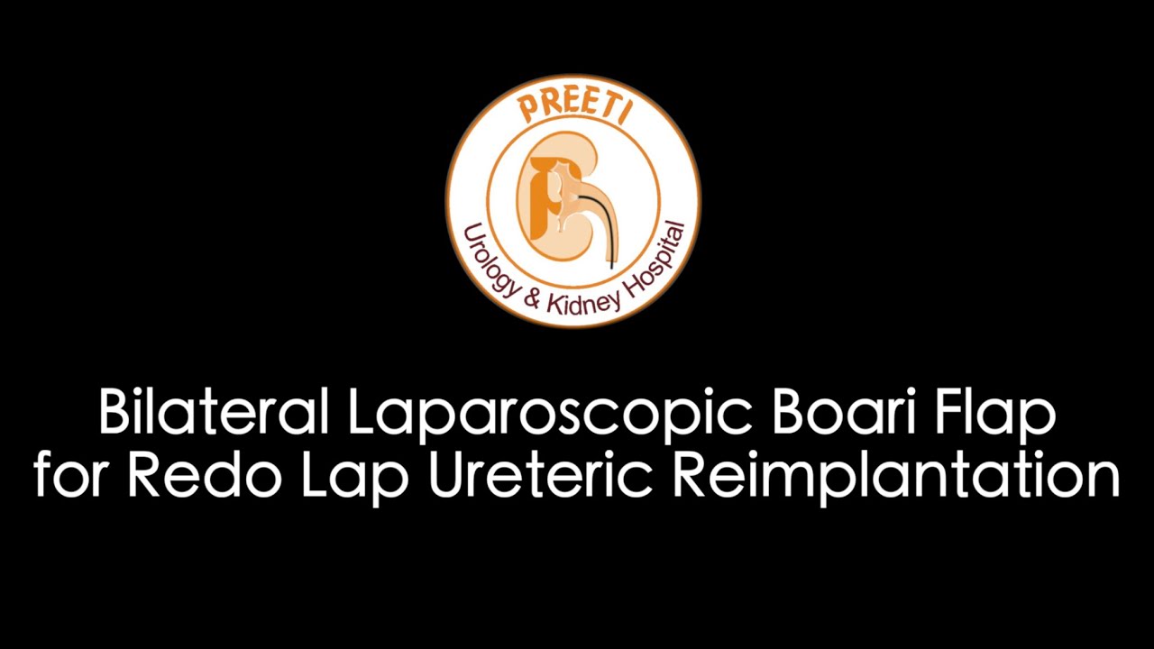 Bilateral Laparoscopic Boari Flap for Redo Laparoscopic Ureteric ...