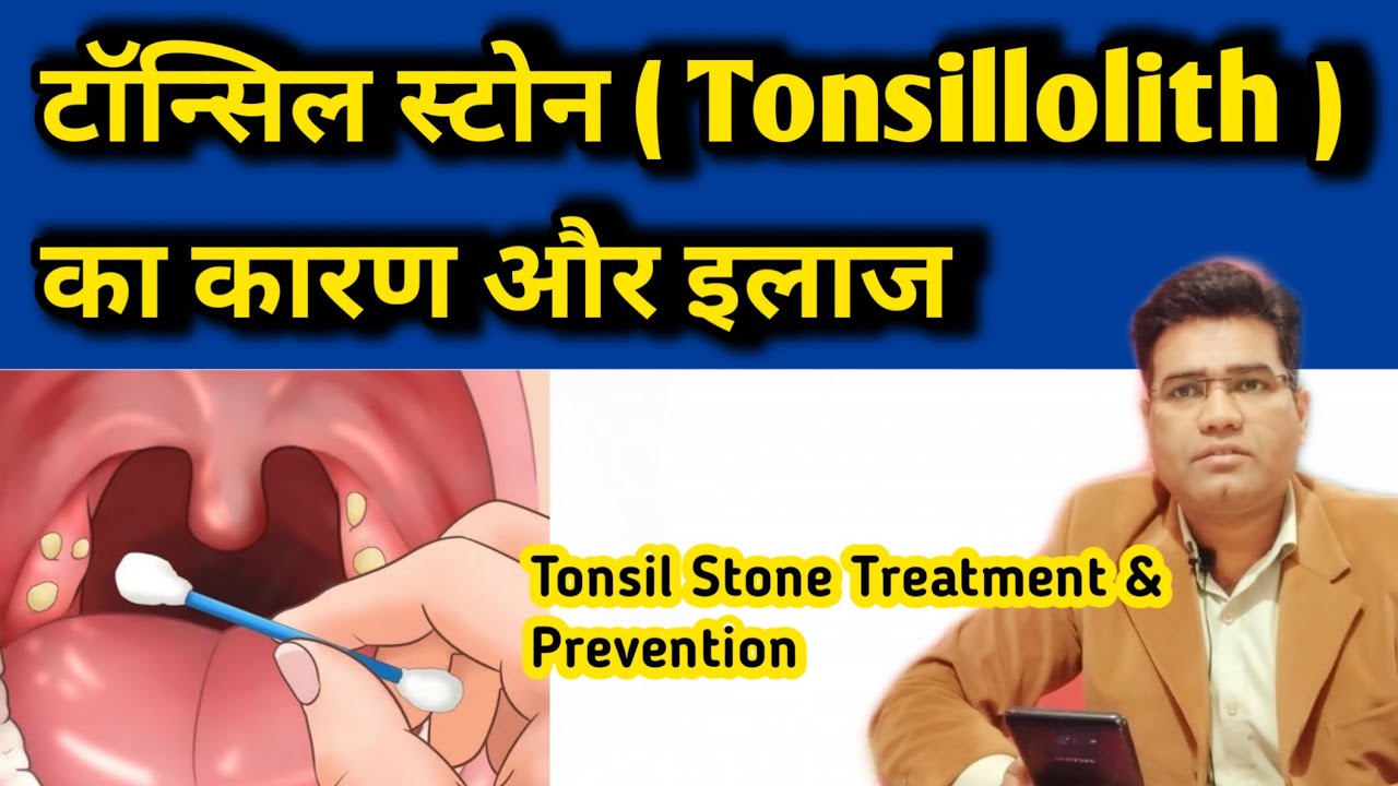What are TonsiIIoliths Cause Symptoms and Treatment | (Tonsil Stone ...
