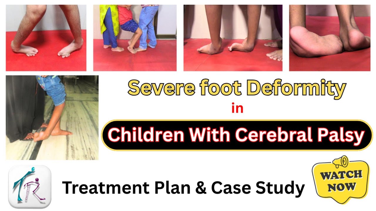 How to Treat Foot Deformity in Children with Cerebral Palsy - Trishla ...