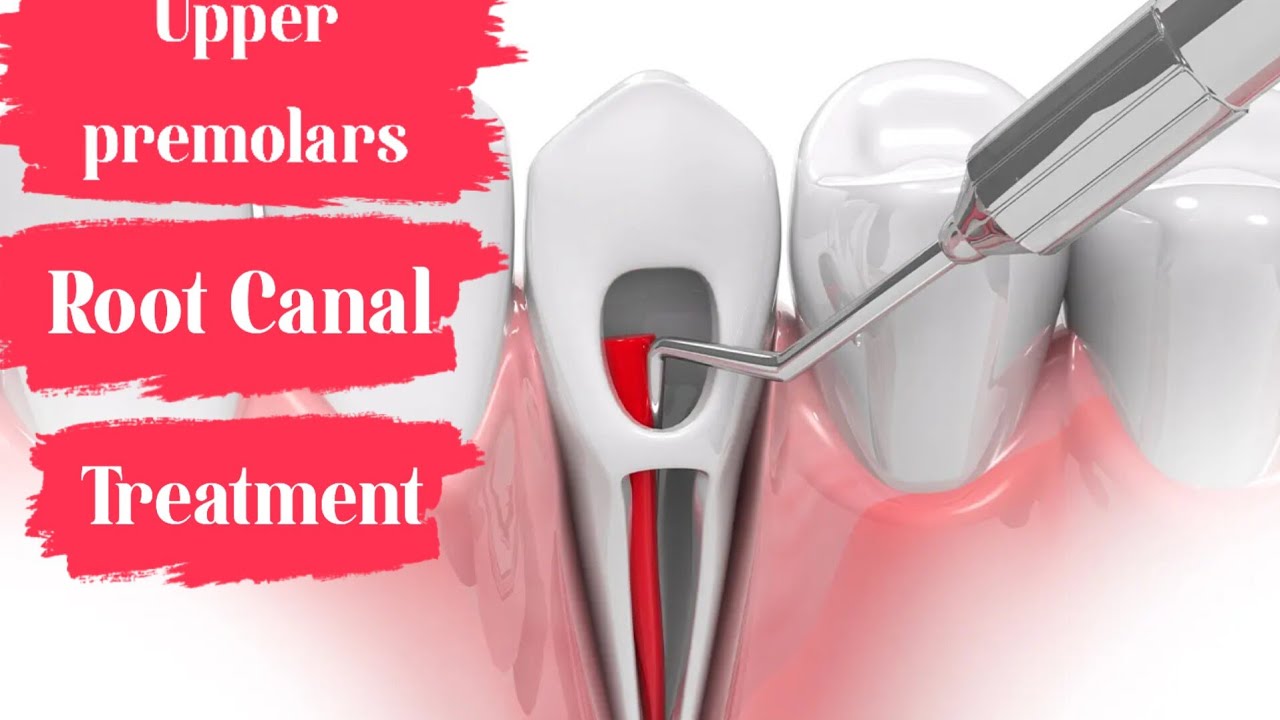 root canal treatment (RCT) #dentist #satisfying#rct dental treatment ...