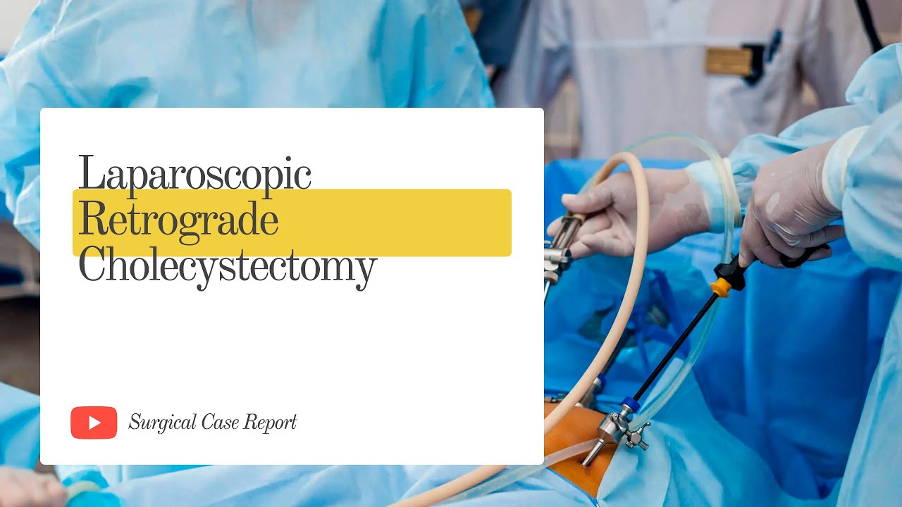 Laparoscopic Retrograde “fundus-first” Cholecystectomy with Endoloop ...