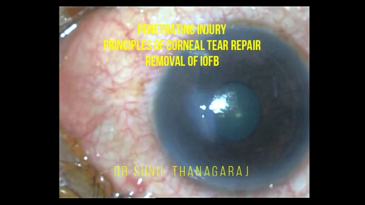 Principles of Corneal tear repair with IOFB - YouTube