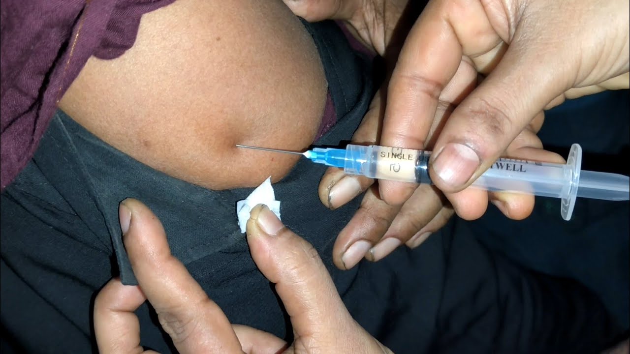 IM Intramuscular Arm injection Push Dexamethasone injection Ep 37 ...