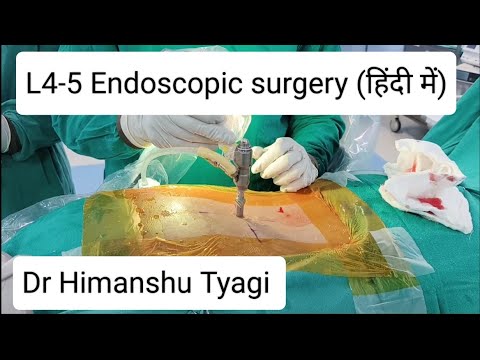 L4-5 Endoscopic lumbar spine Disc Surgery. (slip disc operation/ disc ...