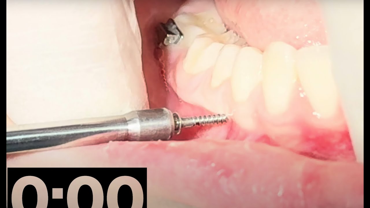 Effortless Mandibular Mini Implant Insertion: Quick, Painless, and ...