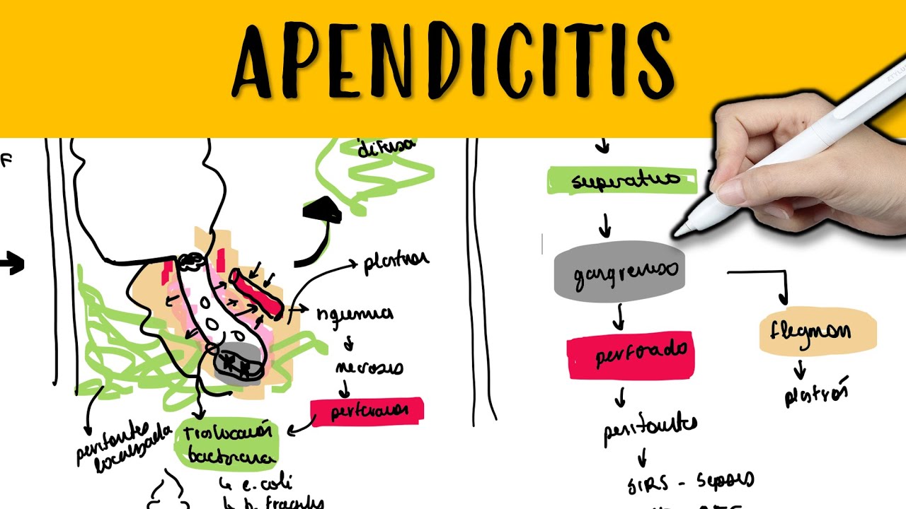 APENDICITIS #blumberg #rovsing #PERITONITIS #laparoscopia # ...