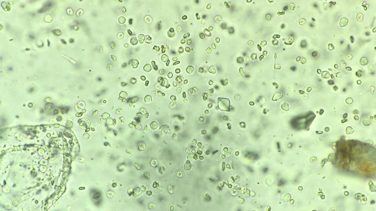 Urine sediment exam | Struvite crystals with pus cells and RBCs - YouTube