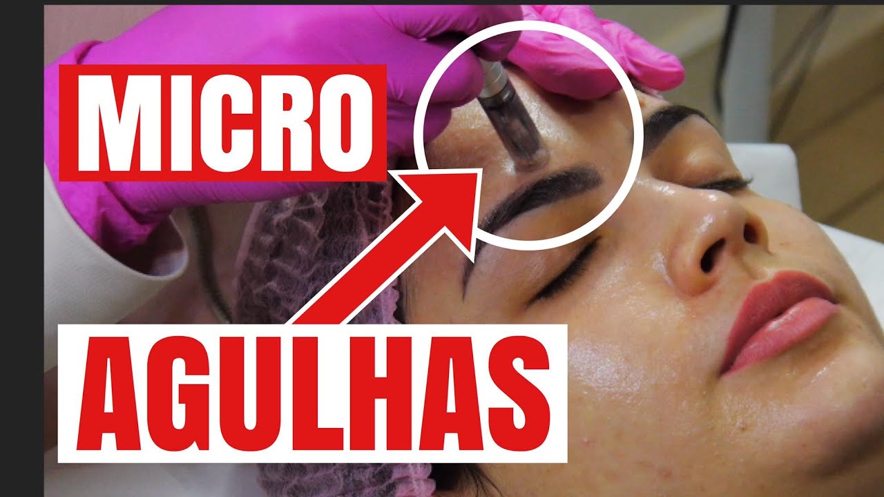 MICROAGULHAMENTO ELÉTRICO para MANCHAS e CICATRIZES de ACNE - YouTube