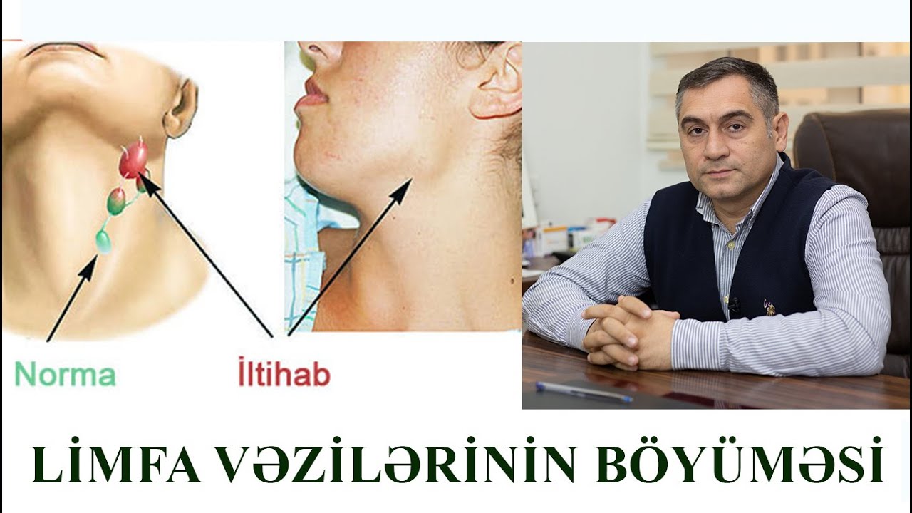 Limfa Vəzilərinin Böyüməsi MÜTLƏQ BAXIN - YouTube