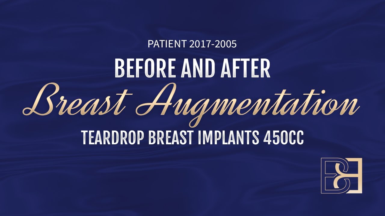 450cc Breast Implant Dual Plane (Augmentation Mammaplasty) {Patient ...