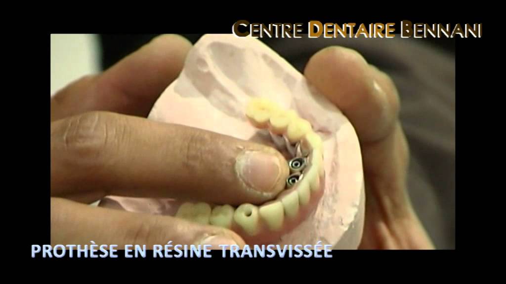 Prothèse Transvissée.flv - YouTube