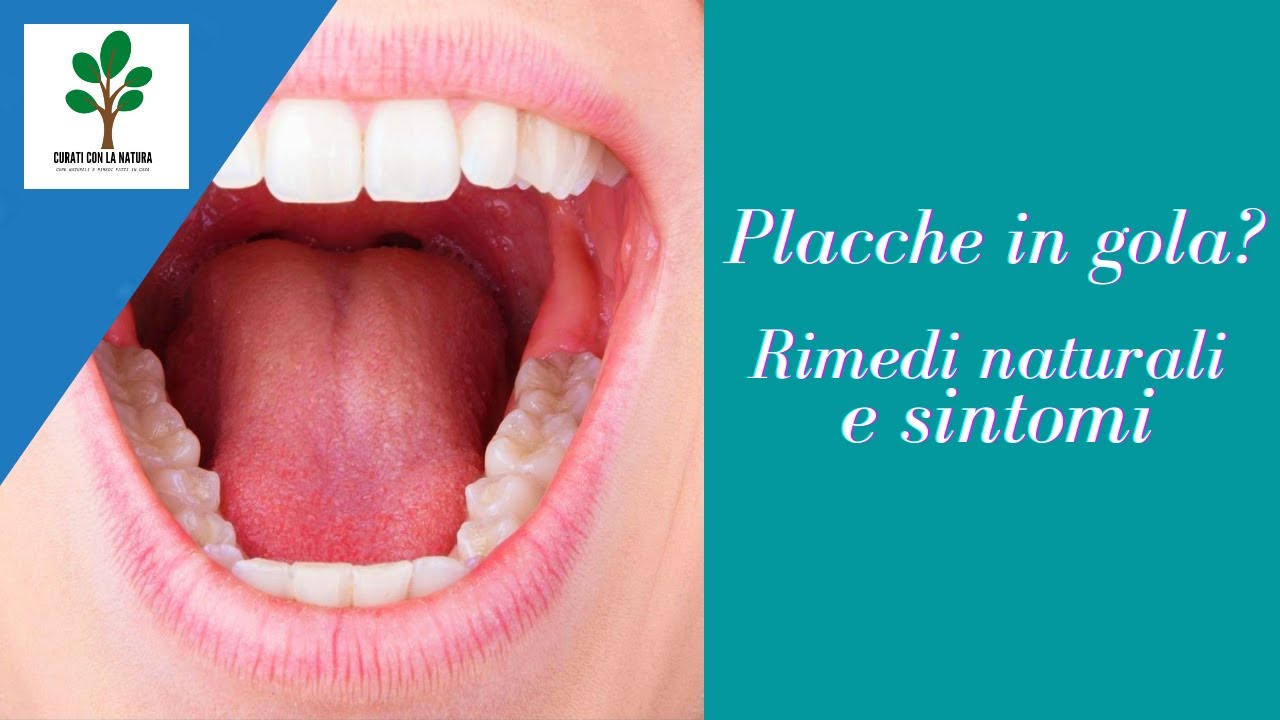 Rimedi naturali contro le placche alla gola - YouTube