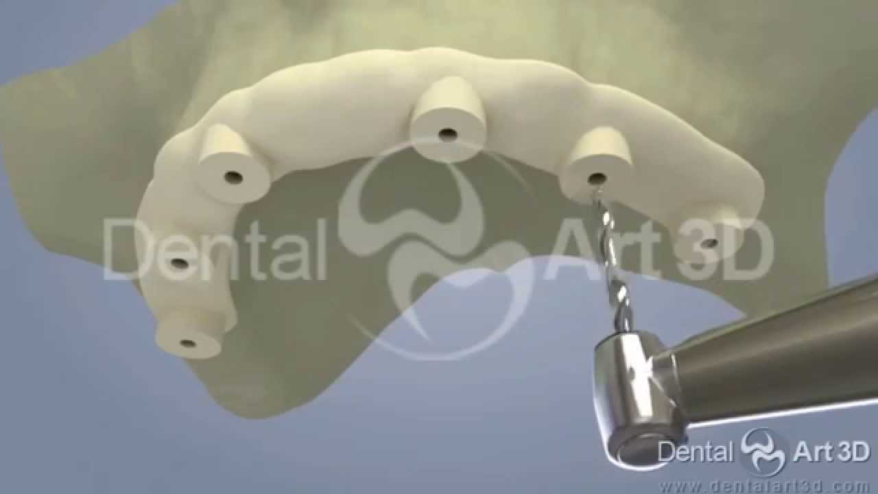 Surgical Guides from DentalArt3D General Dentistry - YouTube