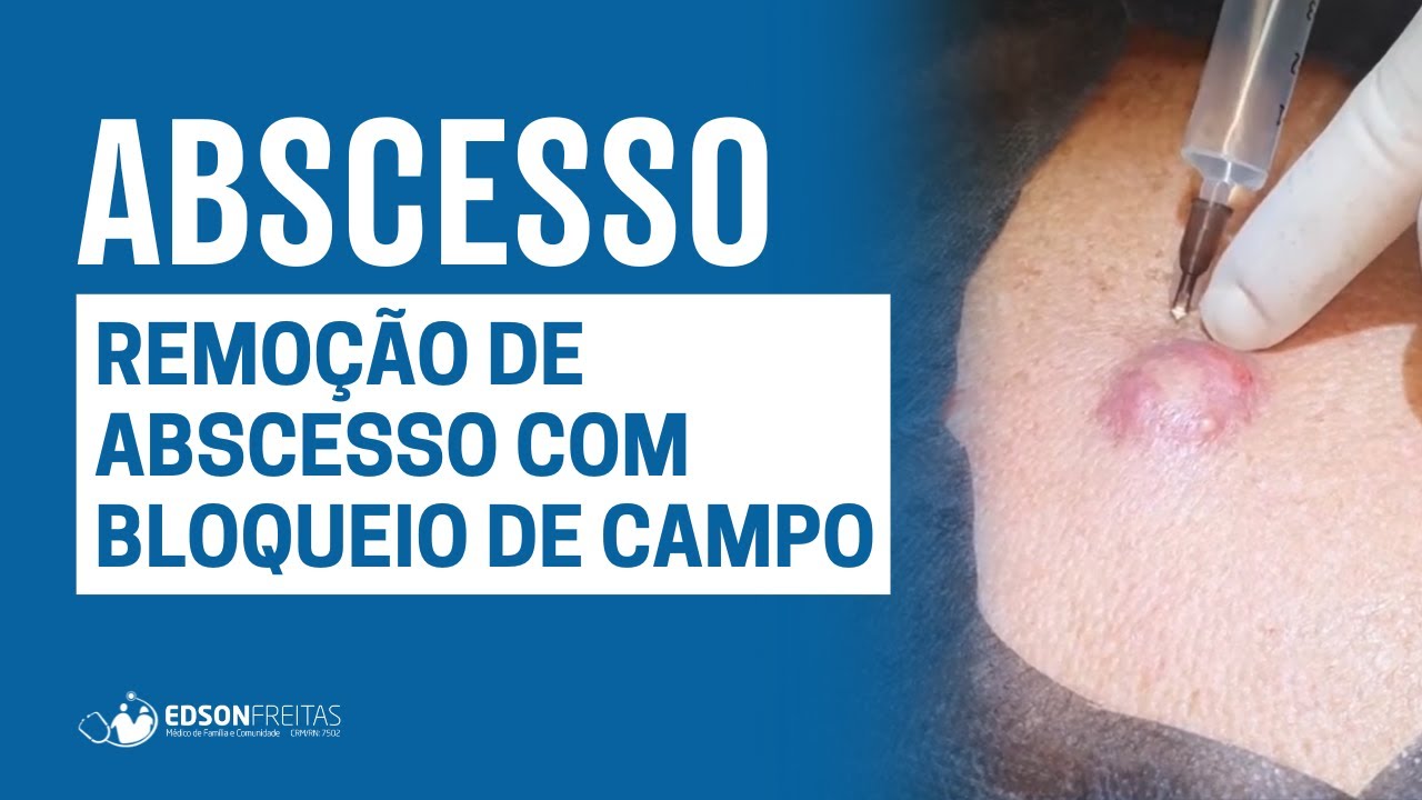 Drenagem de ABSCESSO com BLOQUEIO DE CAMPO! - YouTube