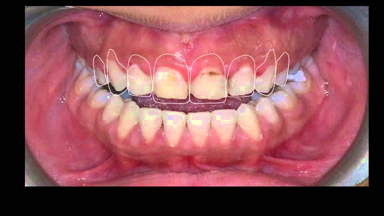 DSD, E-Max veneers for upper four anterior teeth - YouTube