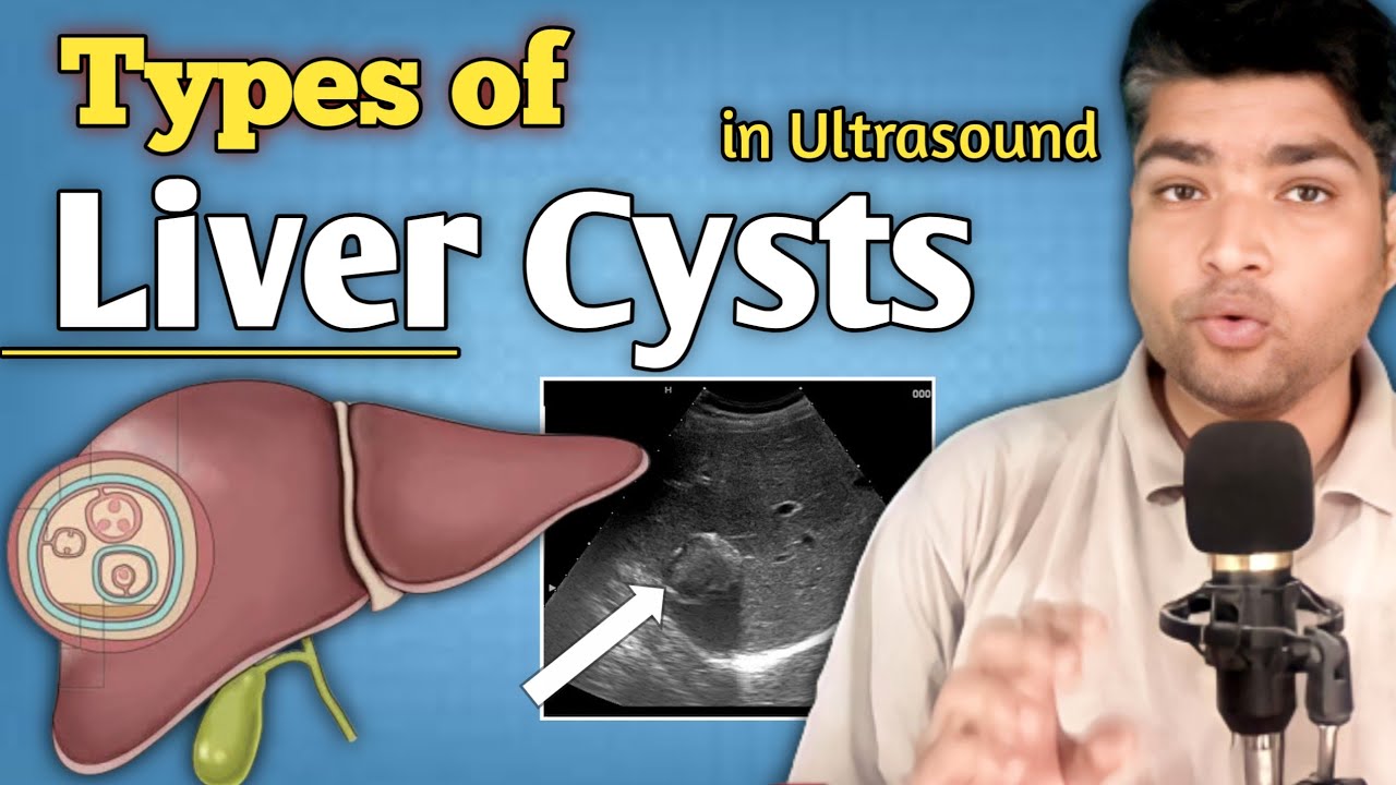Types of Liver Cysts in Ultrasound by Dr Ali Waqar | Hadatid Cyst ...