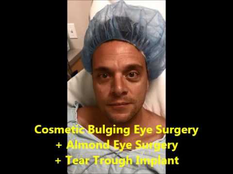 William Cosmetic Bulging Eye Surgery - YouTube