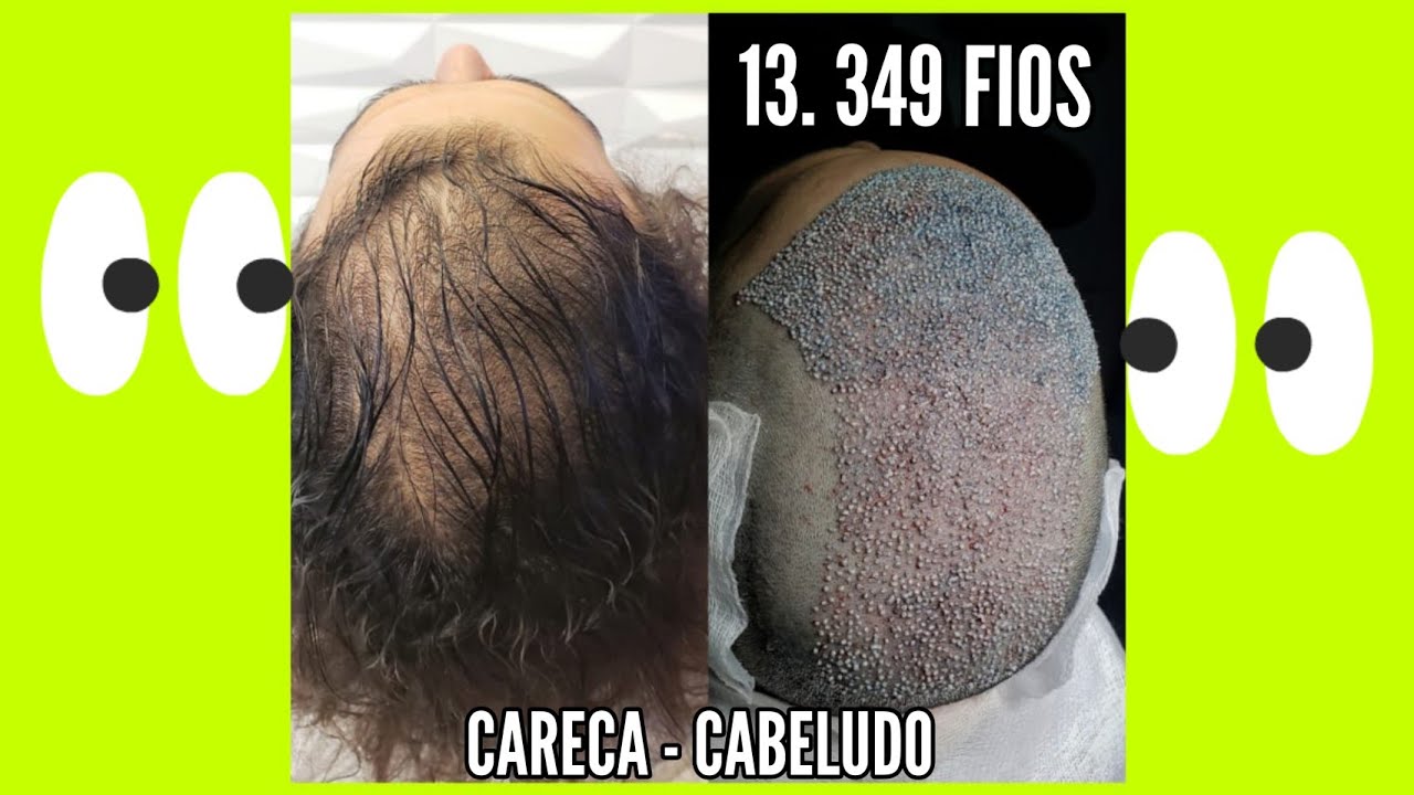 TRANSPLANTE CAPILAR CARECA CABELUDO - 13.273 fios #padraocmc ♨️®️ - YouTube