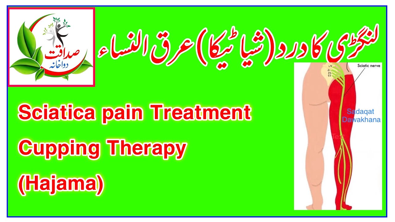 “Sciatica Pain Relief with Cupping Therapy (Hijama) | Dr. Sadaqat ...