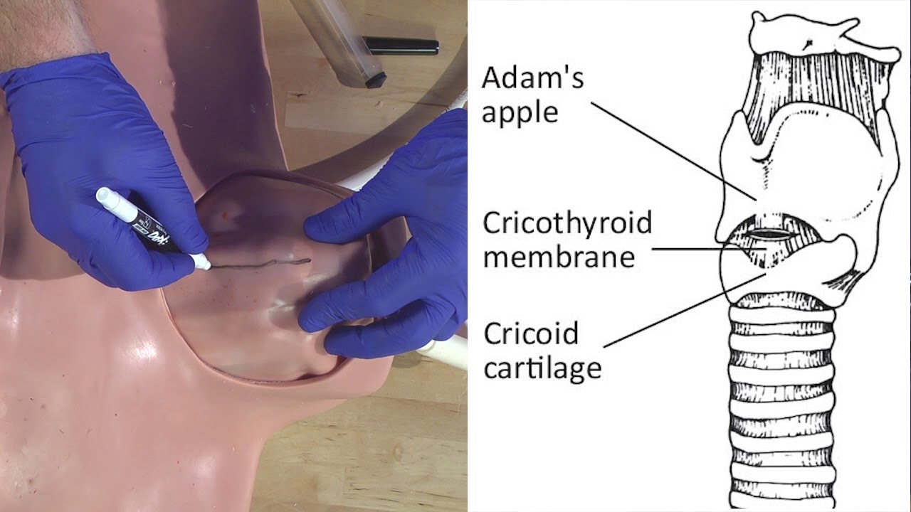 Cricothyroid Membrane Incision