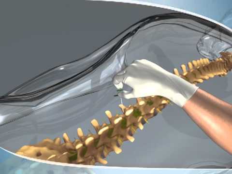 What to expect during a Myelogram procedure at CDI in Orlando, Florida ...