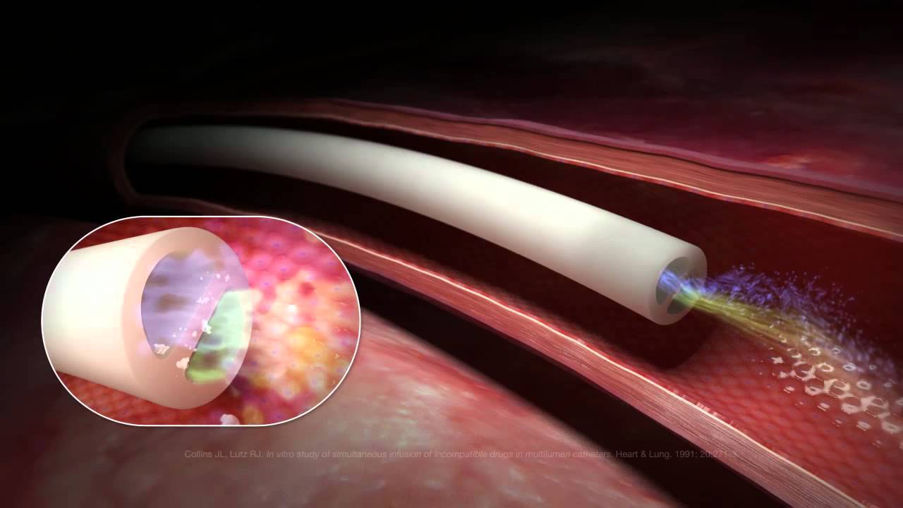 Incompatible Infusates_Arrow Staggered Vs Adjacent Exit Ports.mov - YouTube
