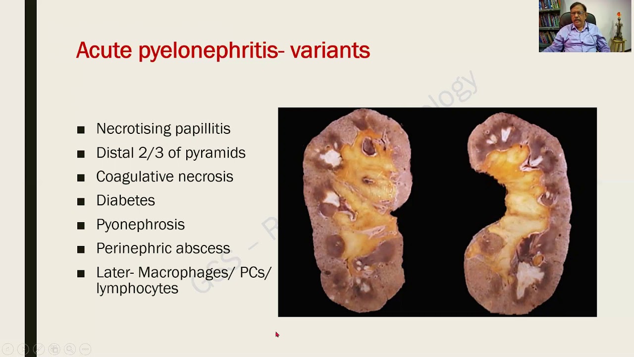 Pyelonephritis - Renal Pathology - R.A.T.S in Pathology - YouTube