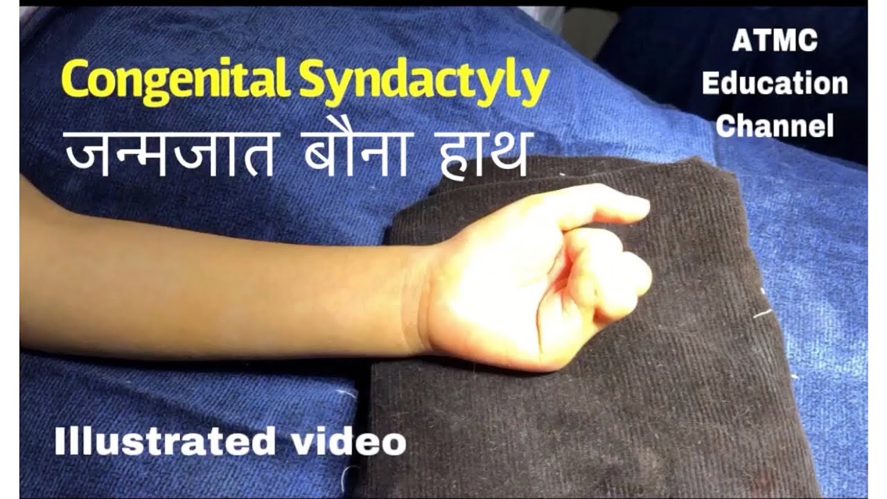 Club hand,syndactyly,congenital hand deformity,hand reconstruction ...