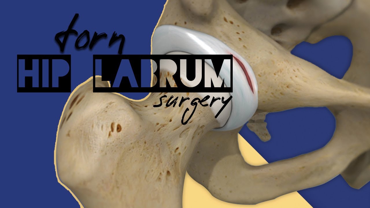 Hip Labral Tear Surgery Vs Physical Therapy at Natasha Moulton blog