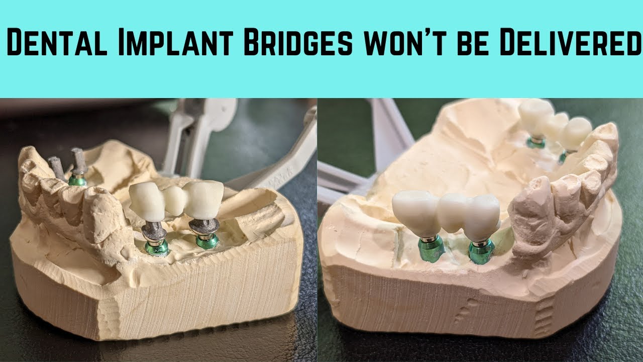 Close up look at 2 three unit Trinia implant bridges - YouTube