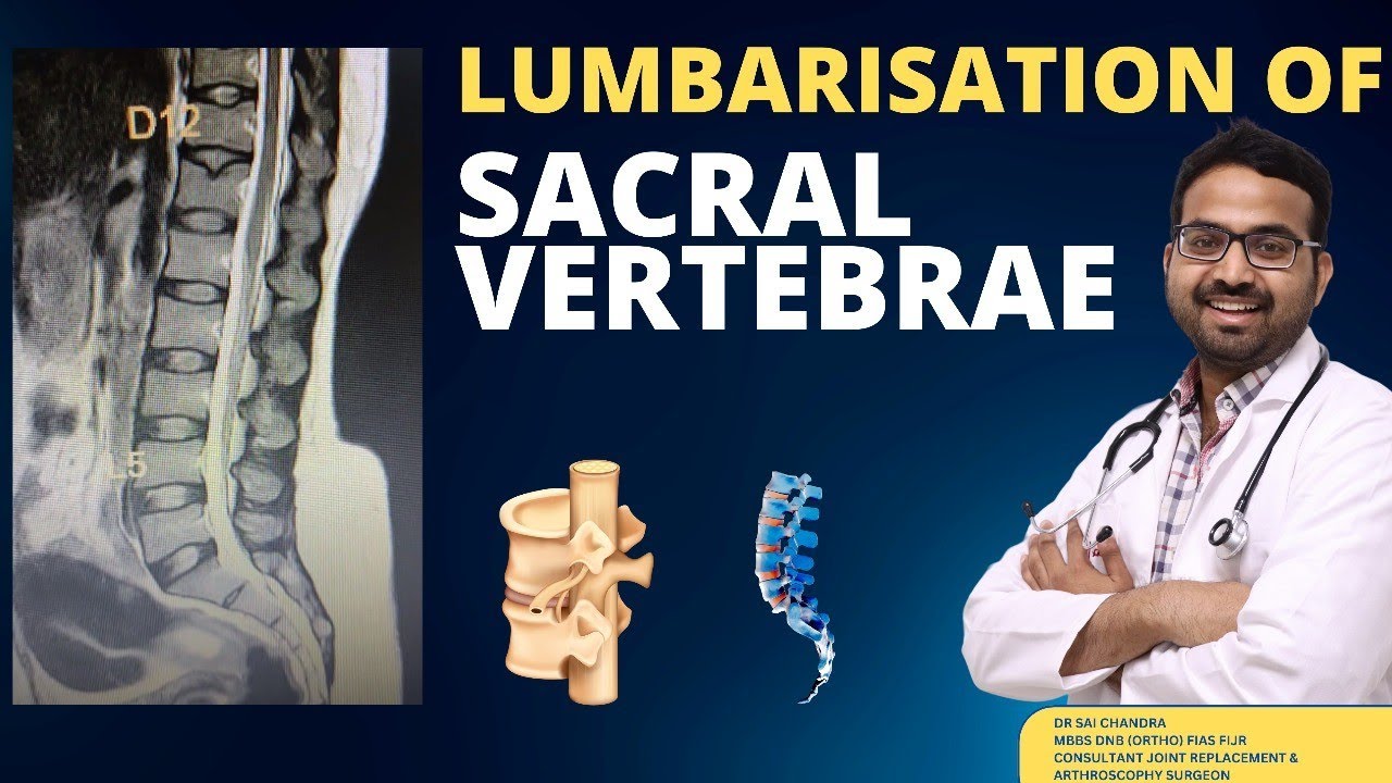 Lumbarisation of Sacral Vertebrae...Dr Sai Chandra MBBS DNB Ortho - YouTube