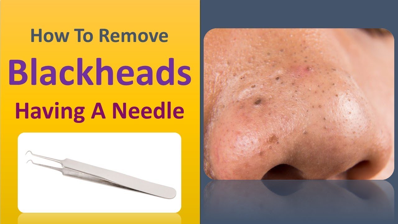 How to Remove Blackheads having a needle - YouTube