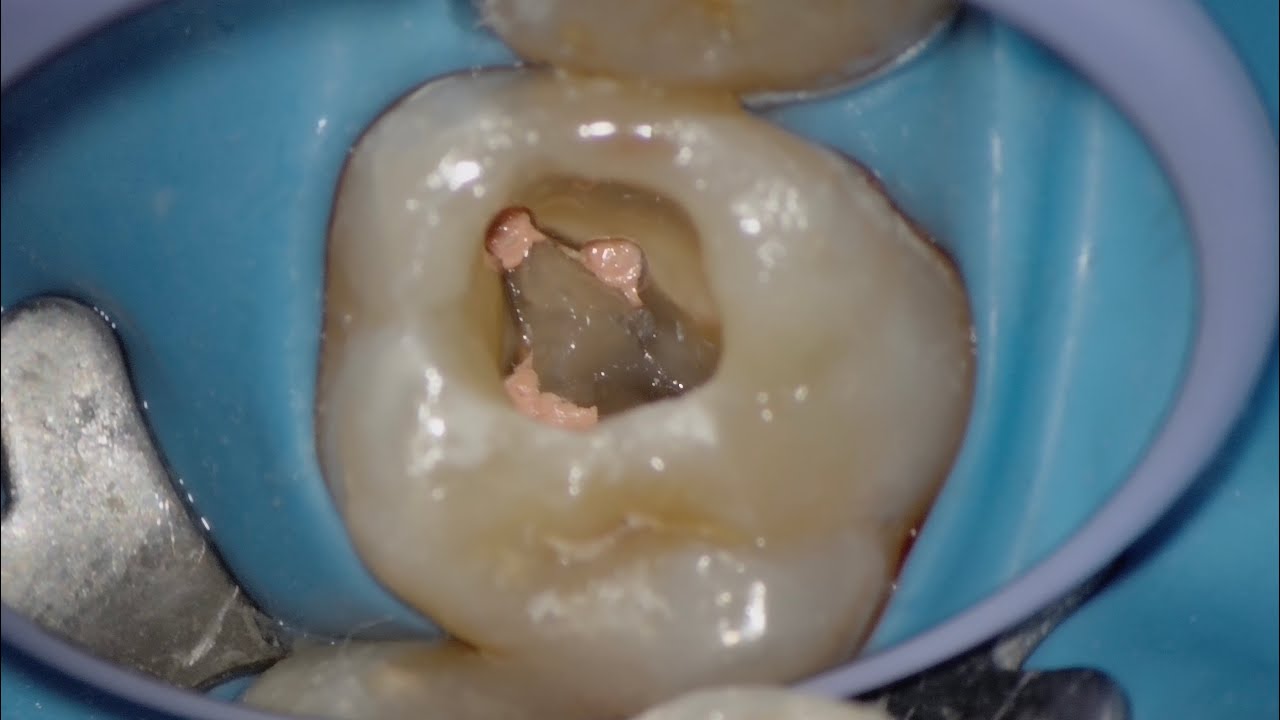 RCT in upper 1st molar - YouTube