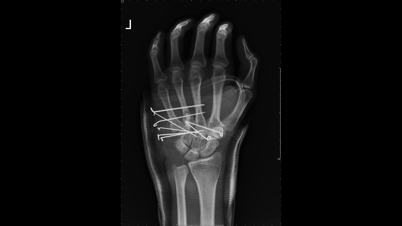 2021 06 23 hamate fx, metacarpal fracture dislocation - YouTube