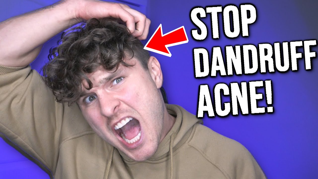 DANDRUFF CAUSES ACNE! (HOW TO GET RID OF BOTH) - YouTube