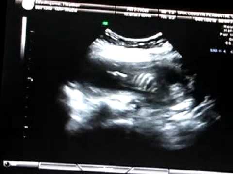 Level 3 Ultrasound - YouTube