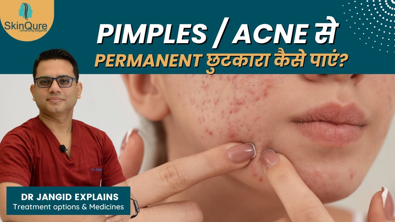 How to get rid of Acne/Pimples | Treatment Options & Medications | Dr ...