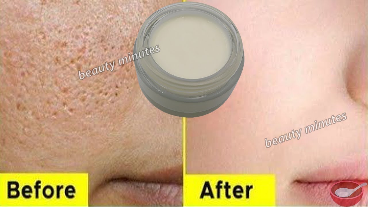 The fastest home recipe to get rid of wide pores, pimples and skin fat ...