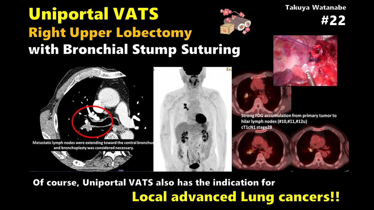 No.22 Uniportal VATS Right Upper Lobectomy with Bronchial Stump ...