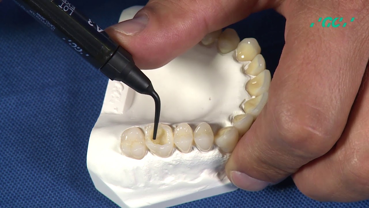 G-AENIAL UNIVERSAL FLO GC Composito Iniettabile - YouTube